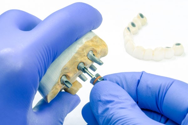 Custom Abutments, Implant Services - Elite Dental Lab